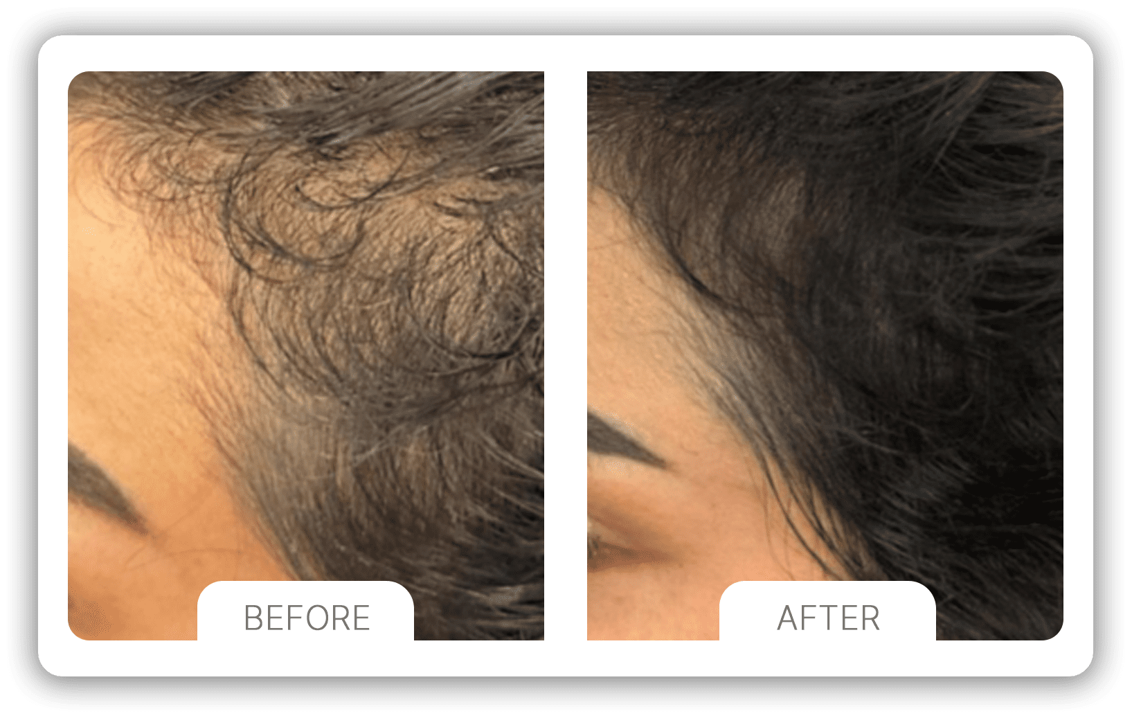 Purasomes For Hair - Saddle House Medi-Spa