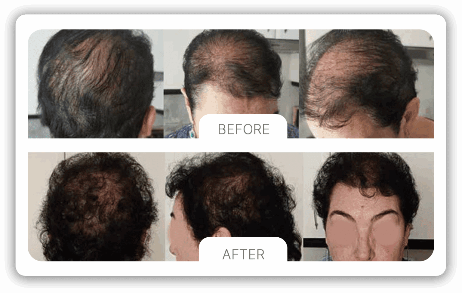 Purasomes For Hair - Saddle House Medi-Spa