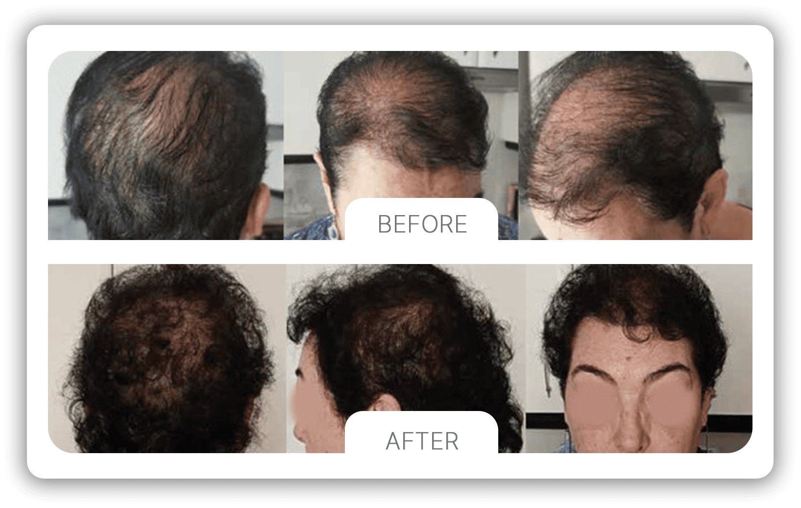 Purasomes For Hair - Saddle House Medi-Spa