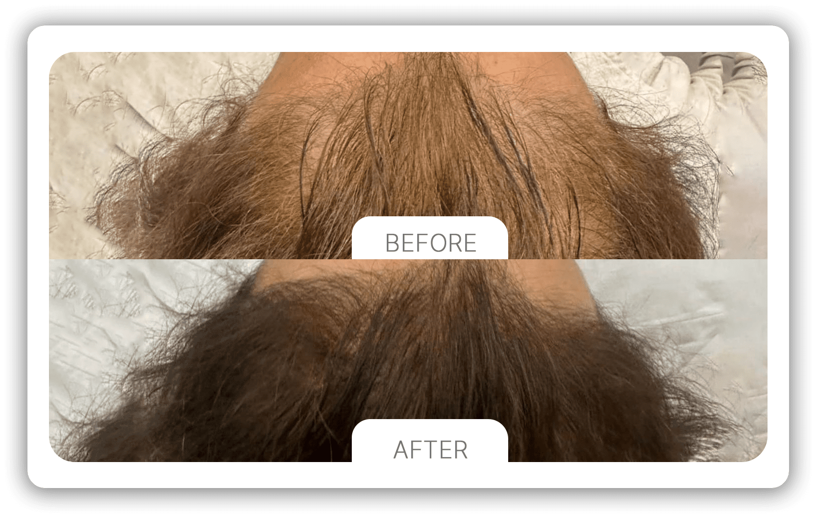 Purasomes For Hair - Saddle House Medi-Spa